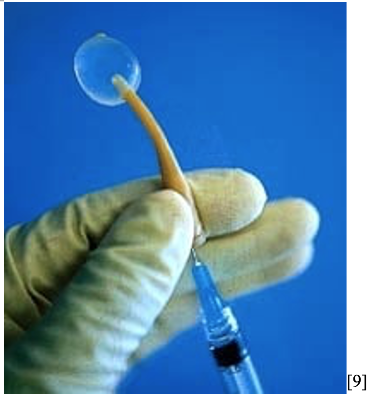 EM@3AM: Bartholin’s Abscess - emDocs