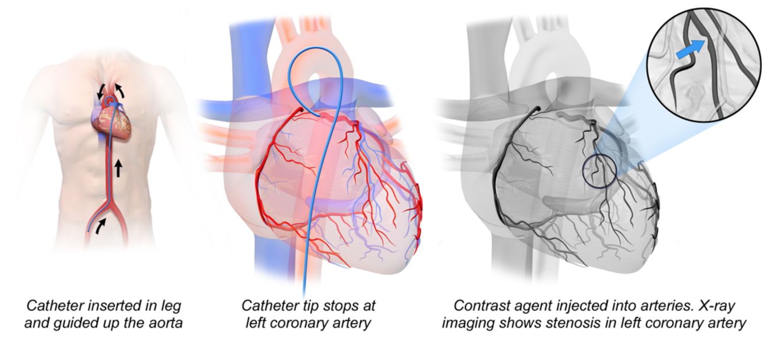 Left Heart Catheterization Complications: ED Presentations, Evaluation ...