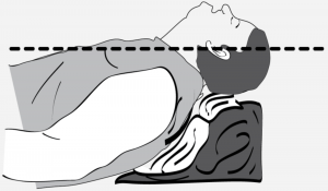 emDOCs Podcast - Episode 74: Upper Airway Obstruction Part 2 - emDocs