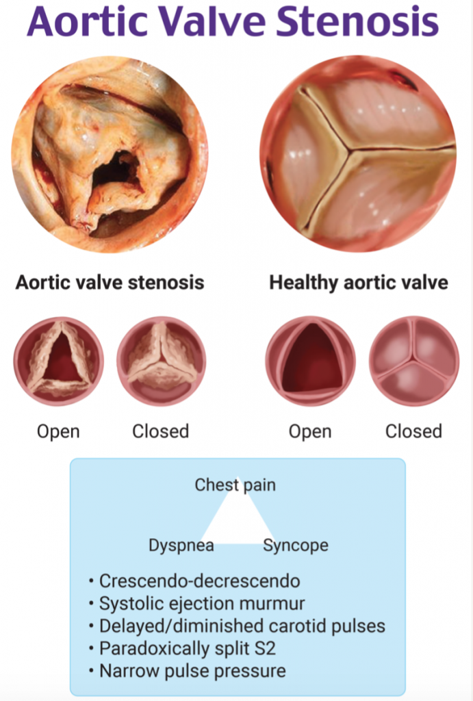 Emergency Medicine Educationem 3am Aortic Stenosis