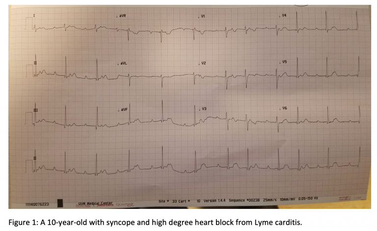 Pediatric Small Talk - A Twist of Lyme: An Approach to Clinical ...