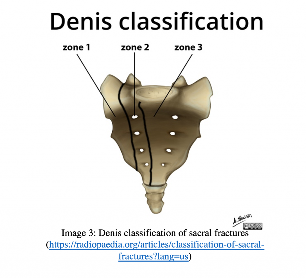 EM@3AM: Sacral fractures - emDocs