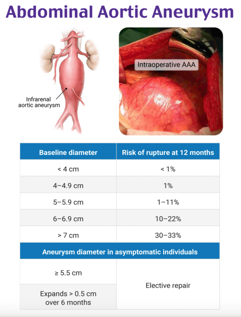EM@3AM: Abdominal Aortic Aneurysm - emDocs