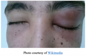 EM@3AM: Periorbital Cellulitis - emDocs