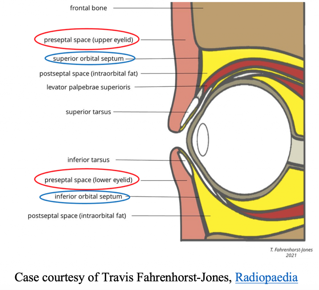 EM@3AM: Periorbital Cellulitis - emDocs