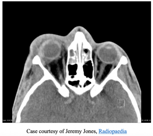 EM@3AM: Periorbital Cellulitis - emDocs