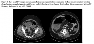 Large bowel obstruction: ED presentation, evaluation, and management ...