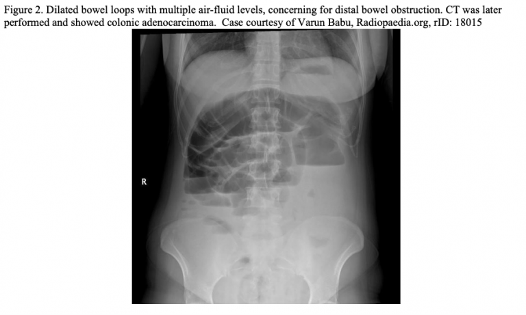 Large bowel obstruction: ED presentation, evaluation, and management ...
