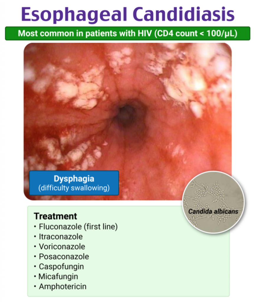 EM@3AM: Oropharyngeal Candidiasis - emDocs