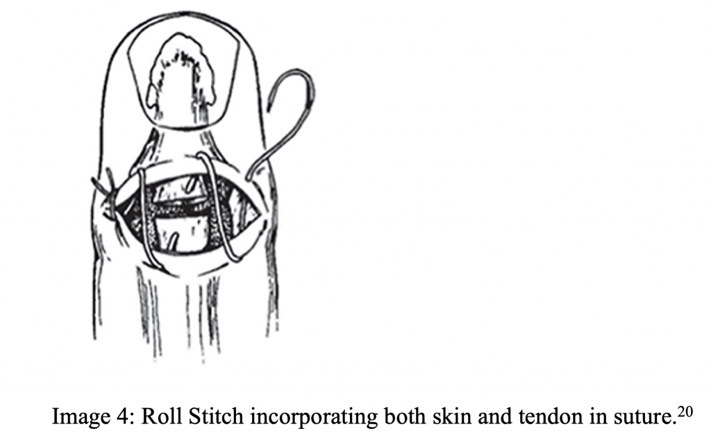 EM@3AM: Extensor Tendon Laceration - emDocs