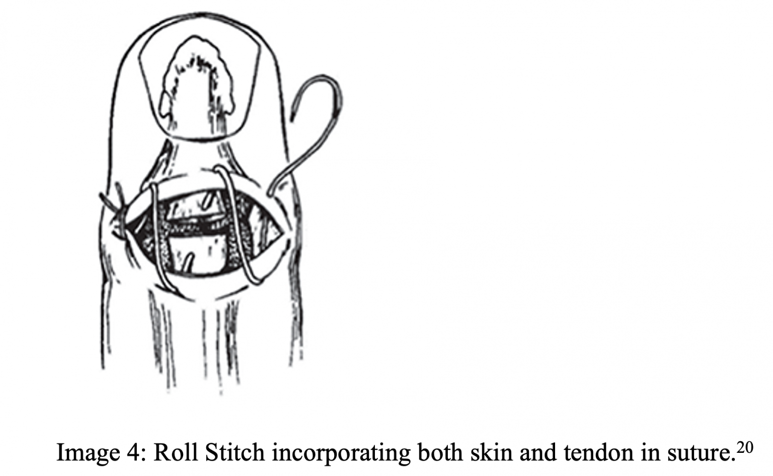 EM@3AM: Extensor Tendon Laceration - emDocs