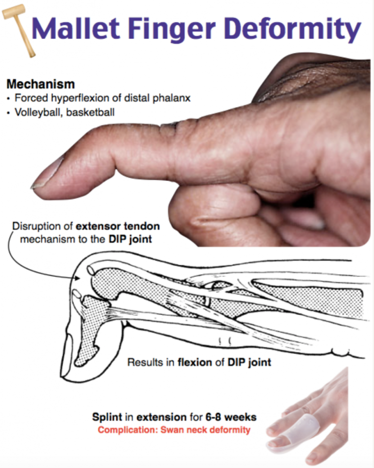 EM@3AM: Extensor Tendon Laceration - emDocs