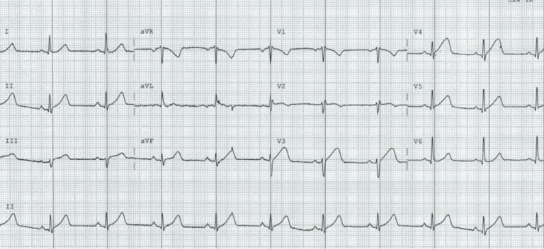 ECG Pointers: STEMI Equivalents from the American College of Cardiology ...