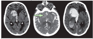 CT Angiography Head and Neck: Indications and Limitations - emDocs