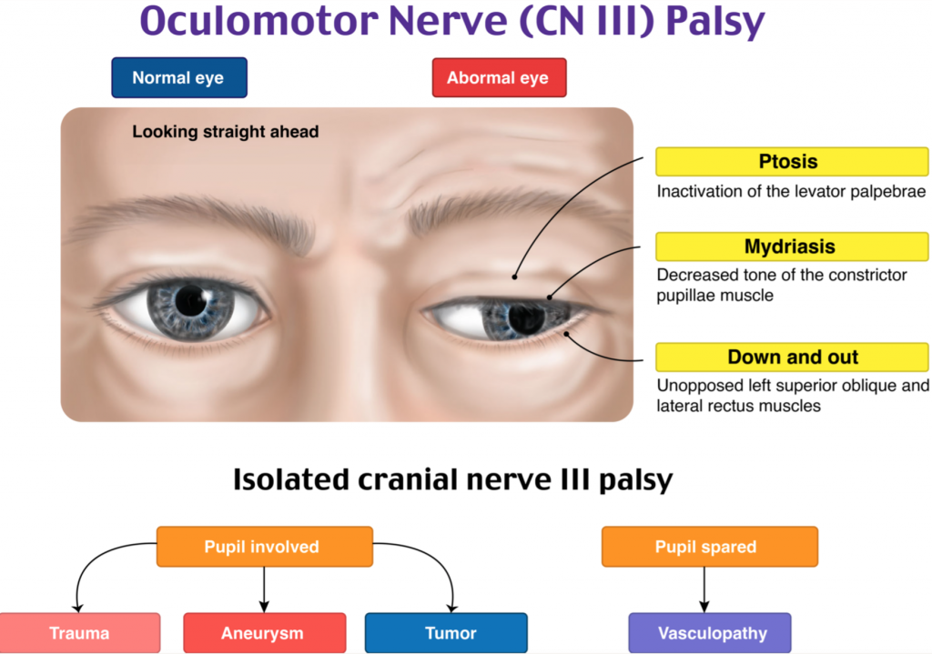 EM@3AM: Oculomotor Nerve Palsy - emDocs