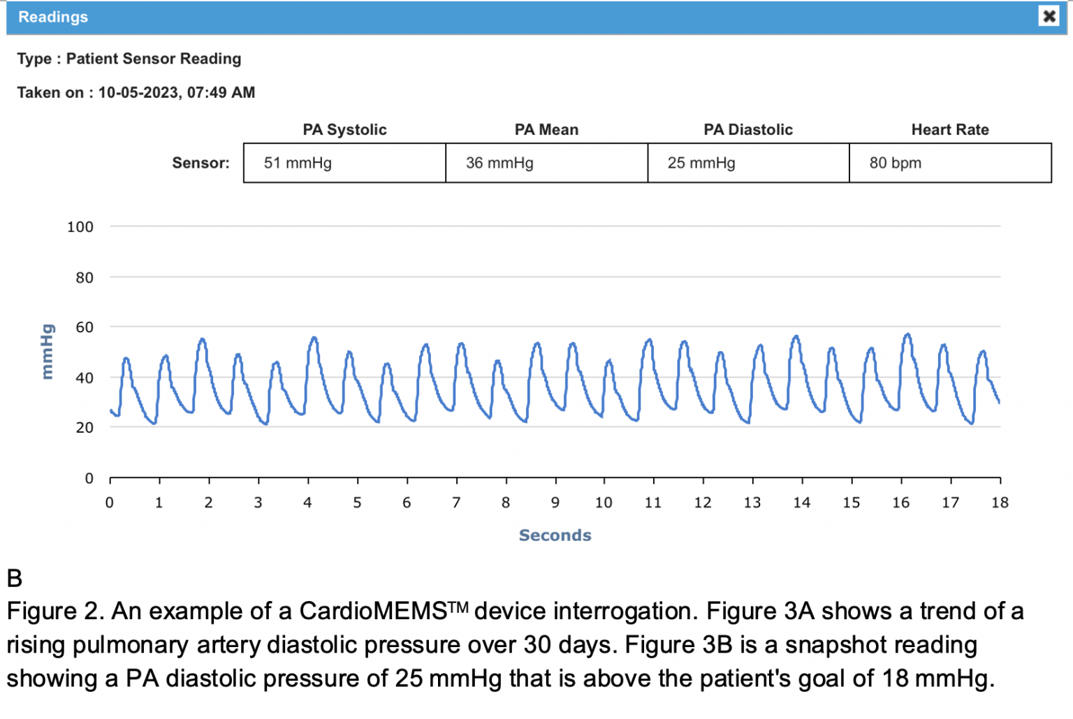What the Emergency Clinician Must Know about Remote Monitors in Heart ...