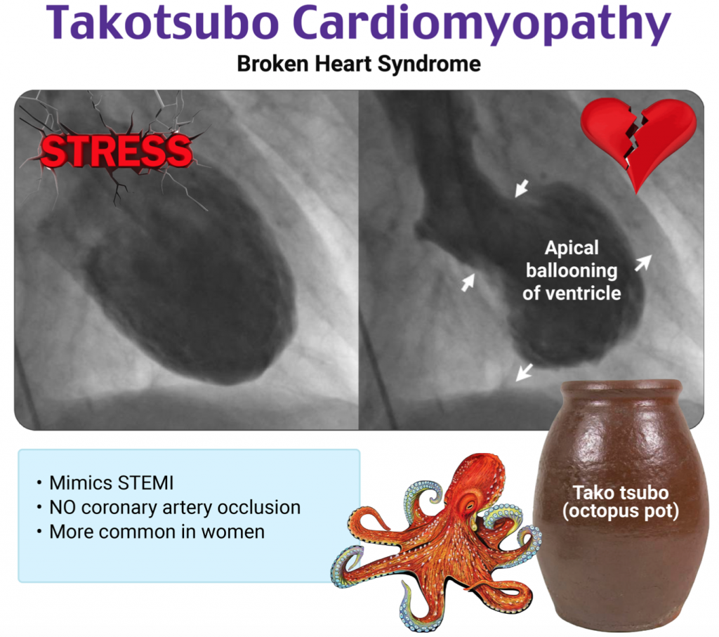 EM@3AM: Takotsubo Cardiomyopathy - emDocs