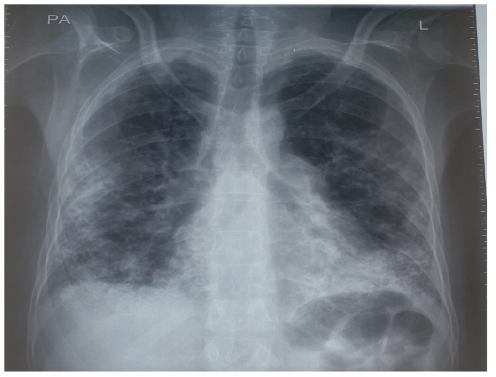 Pneumocystis jirovecii Pneumonia and HIV: A Practical Guide for ED ...