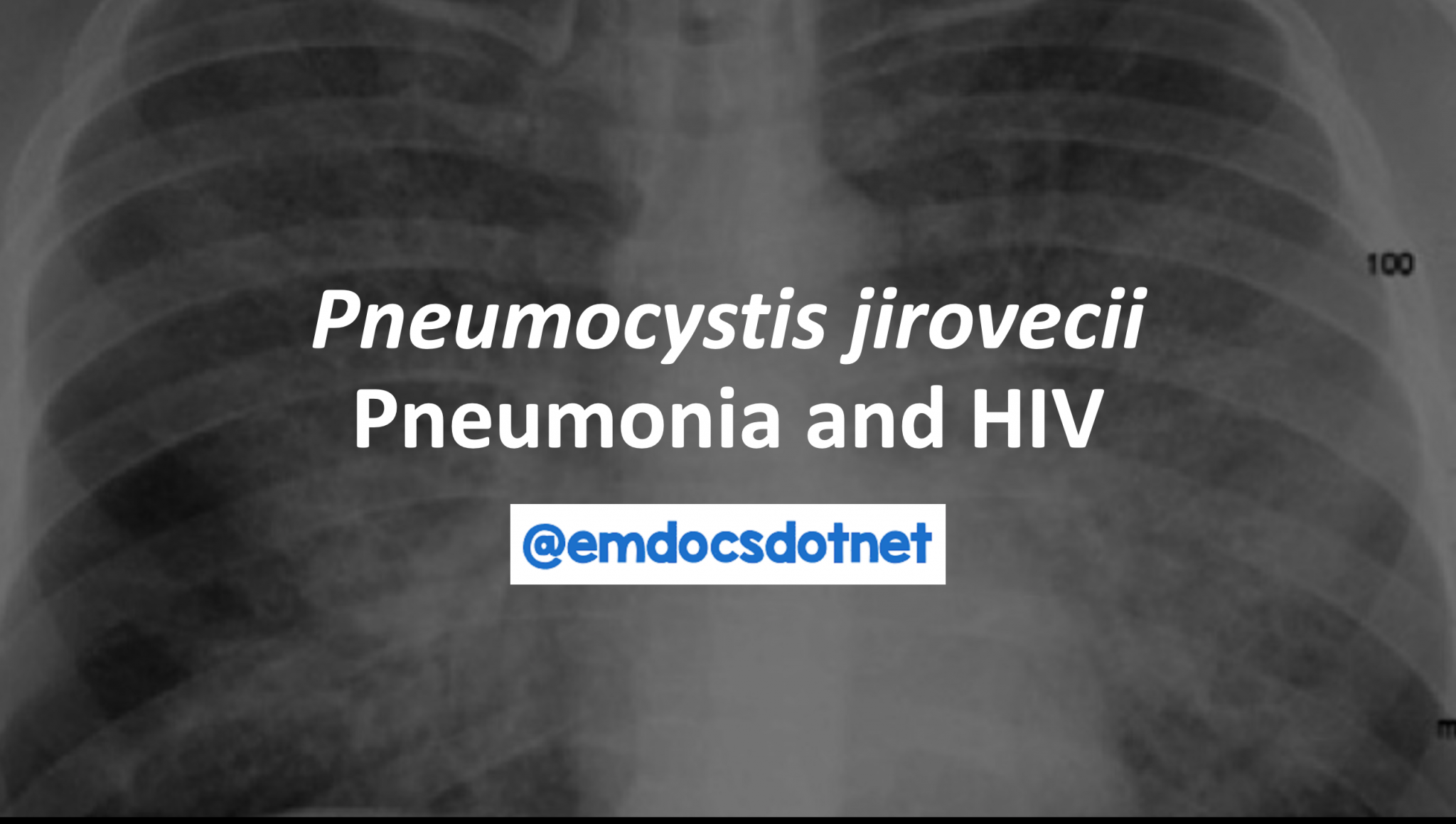 Pneumocystis jirovecii Pneumonia and HIV: A Practical Guide for ED ...