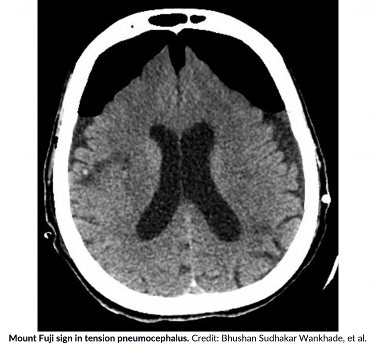 EM@3AM: Pneumocephalus - emDocs