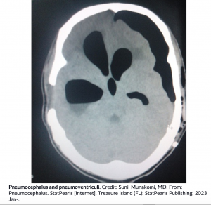 EM@3AM: Pneumocephalus - emDocs