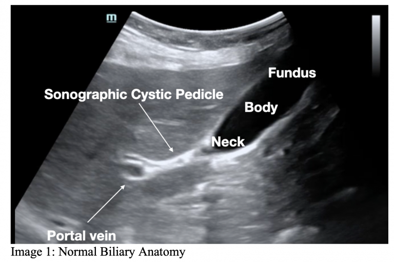 Using Point-of-Care Ultrasound to Identify the Gallbladder - emDocs