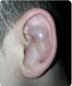 EM@3AM: Auricular Hematoma - emDocs