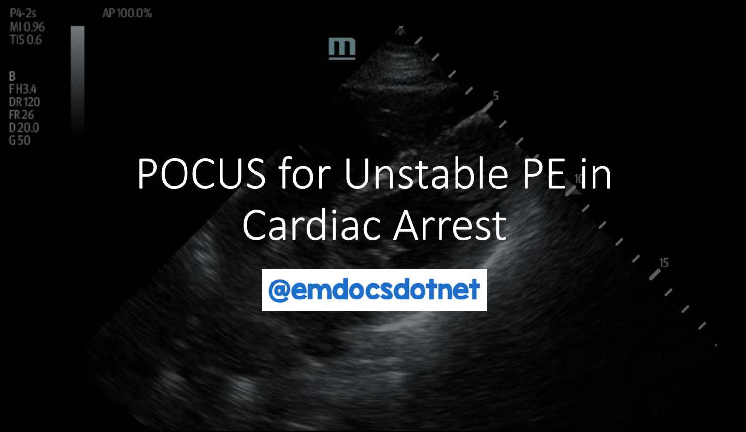 POCUS findings of hemodynamically unstable PE with cardiac arrest - emDocs
