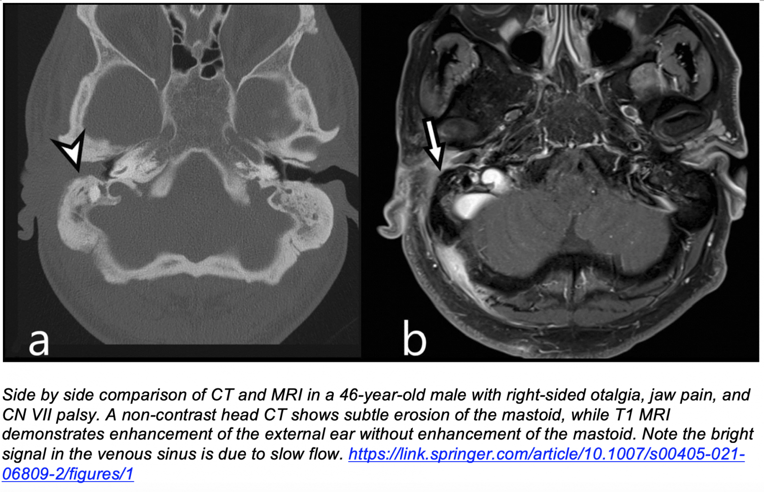 EM@3AM: Malignant/Necrotizing Otitis Externa - emDocs