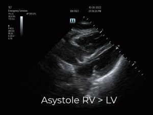 POCUS findings of hemodynamically unstable PE with cardiac arrest - emDocs