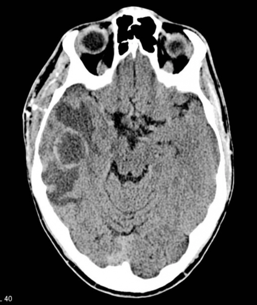 Medical Malpractice Insights: Brain Abscess - emDocs