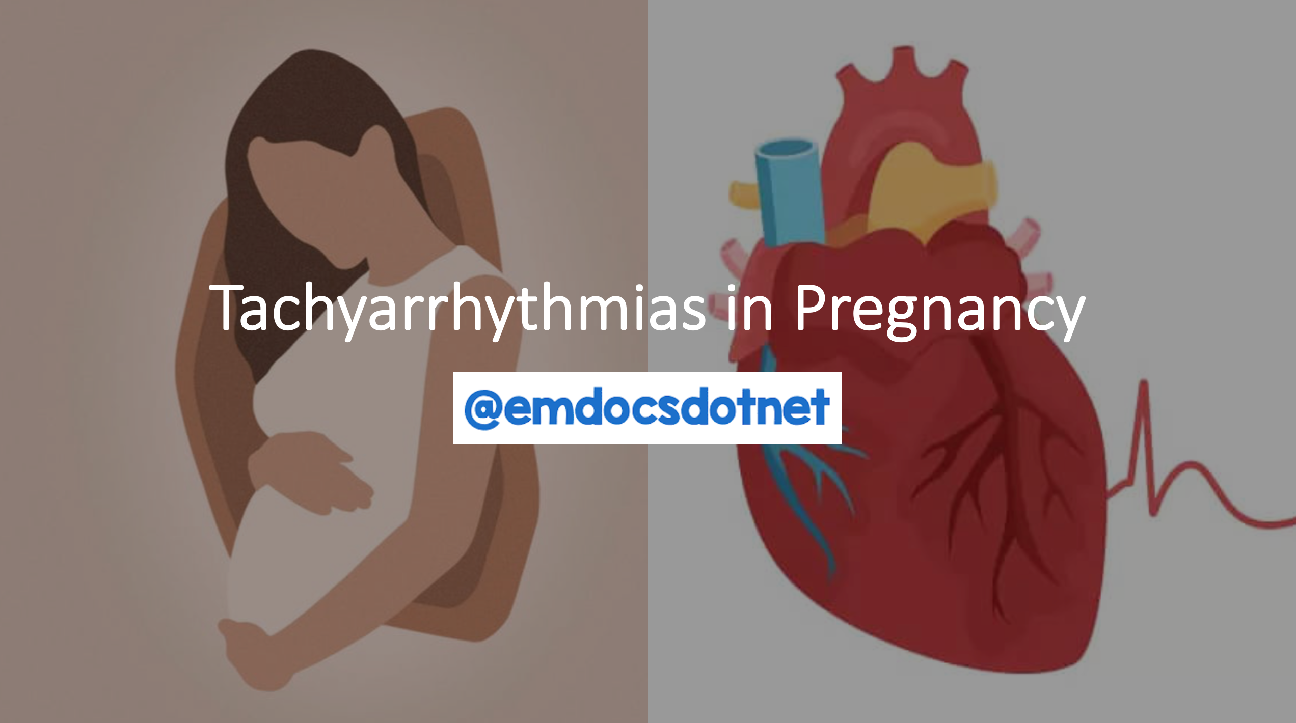 emDOCs.net – Emergency Medicine EducationTachyarrhythmias in Pregnancy ...