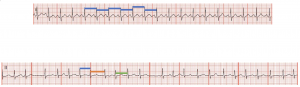 ECG Pointers: A Dynamic Approach to Tachydysrhythmias - emDocs