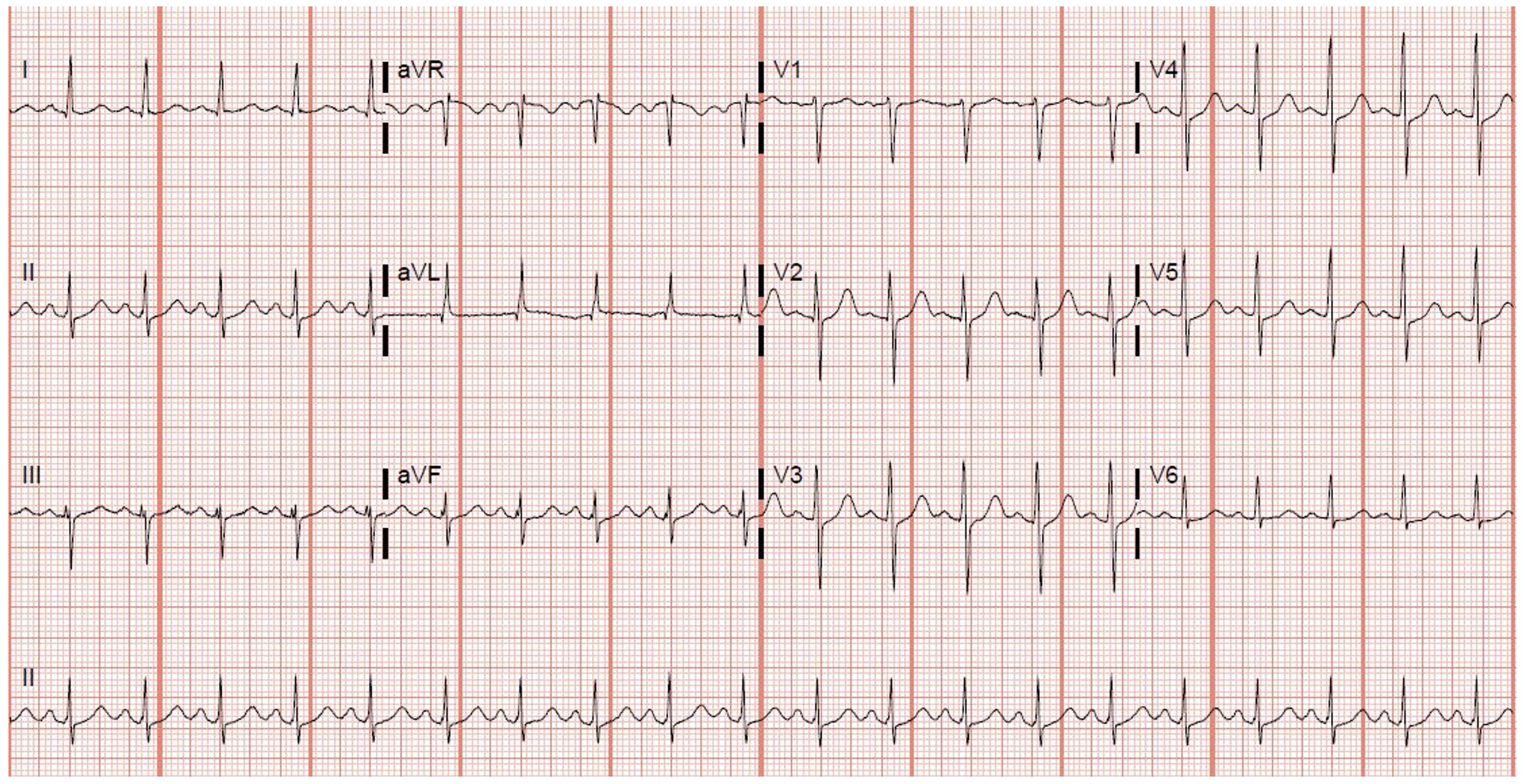 ECG Pointers: A Dynamic Approach to Tachydysrhythmias - emDocs