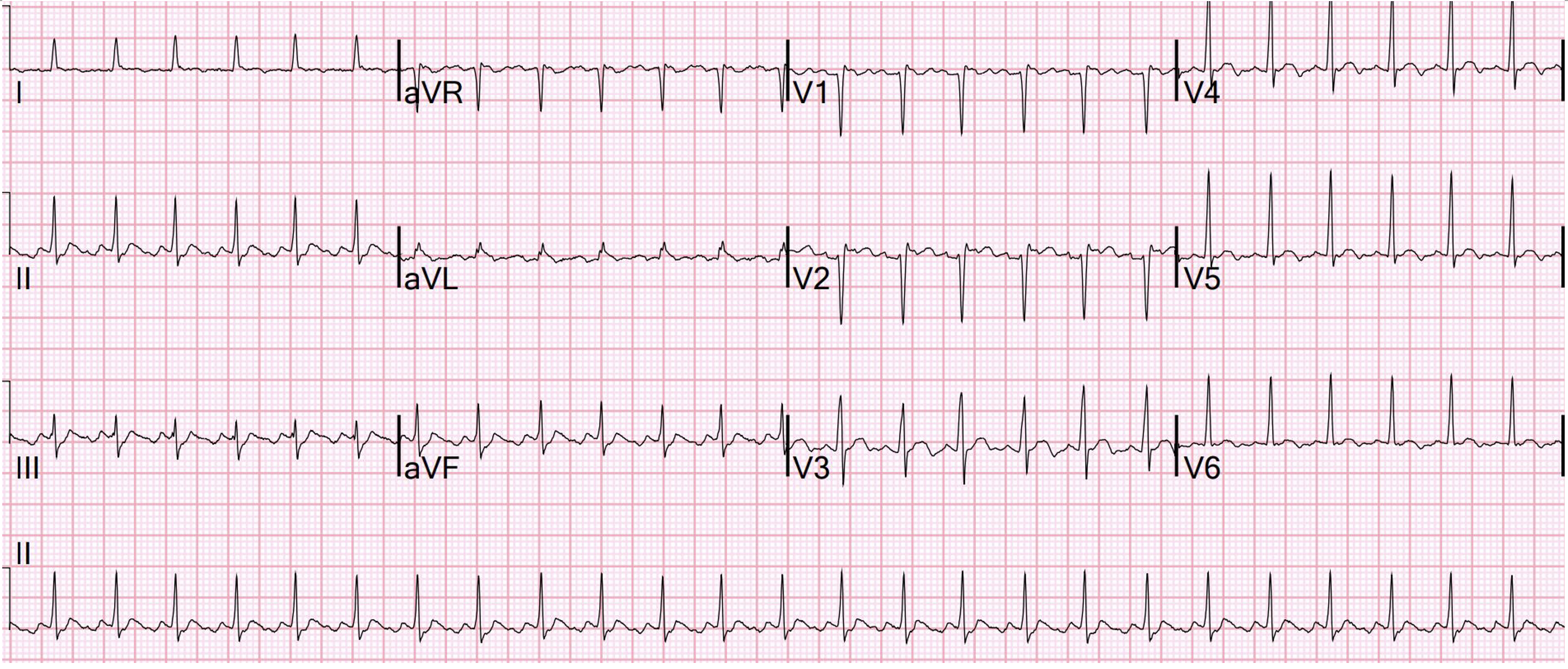 ECG Pointers: A Dynamic Approach to Tachydysrhythmias - emDocs