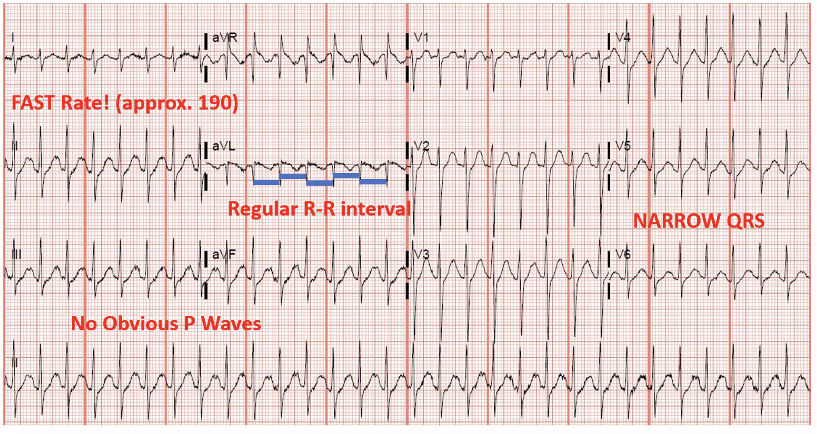 ECG Pointers: A Dynamic Approach to Tachydysrhythmias - emDocs