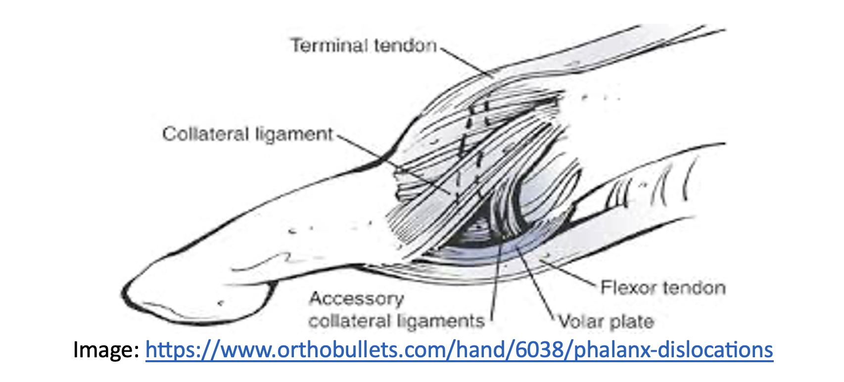 EM @3AM: Phalanx Dislocation - emDocs