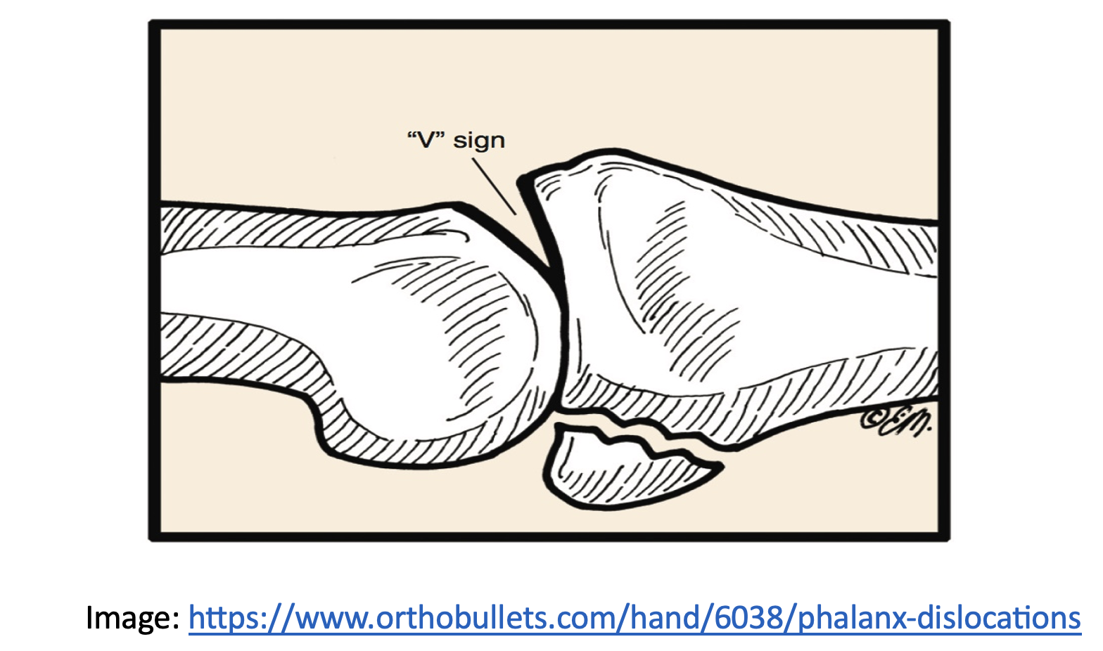 EM @3AM: Phalanx Dislocation - emDocs