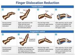 EM @3AM: Phalanx Dislocation - emDocs