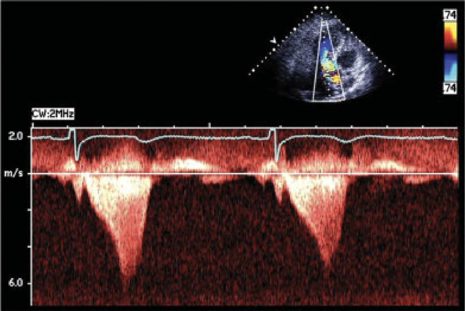emDOCs Podcast – Episode 119: Left Ventricular Outflow Tract ...