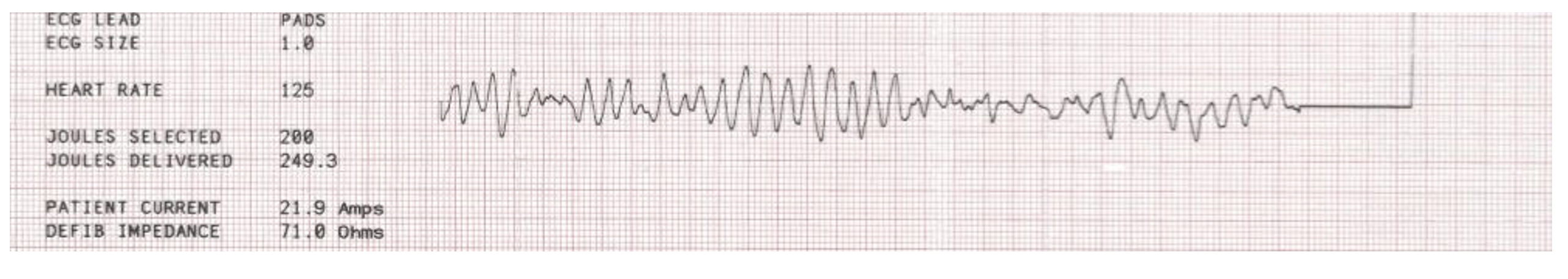 ECG Pointers: A Dynamic Approach to Tachydysrhythmias Part 3 - emDocs
