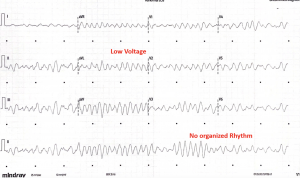 ECG Pointers: A Dynamic Approach to Tachydysrhythmias Part 3 - emDocs
