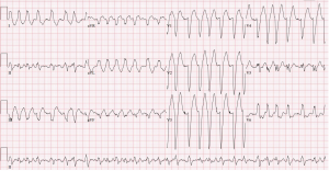 ECG Pointers: A Dynamic Approach to Tachydysrhythmias Part 3 - emDocs