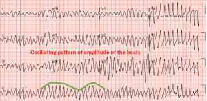 ECG Pointers: A Dynamic Approach to Tachydysrhythmias Part 3 - emDocs