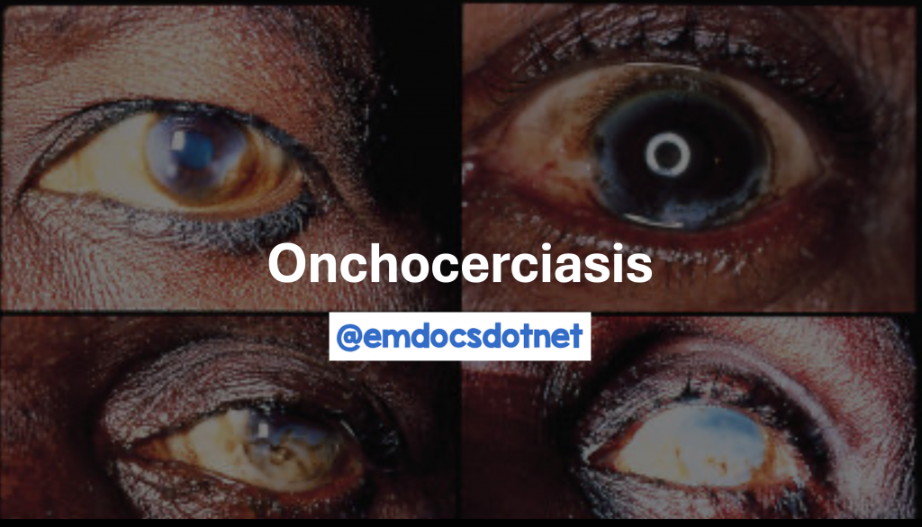 emDOCs.net – Emergency Medicine EducationUpdates on Onchocerciasis ...