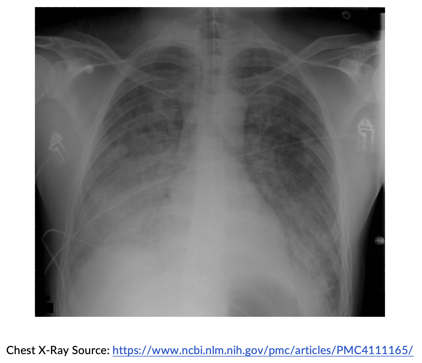 EM@3AM: Murine Typhus - emDocs
