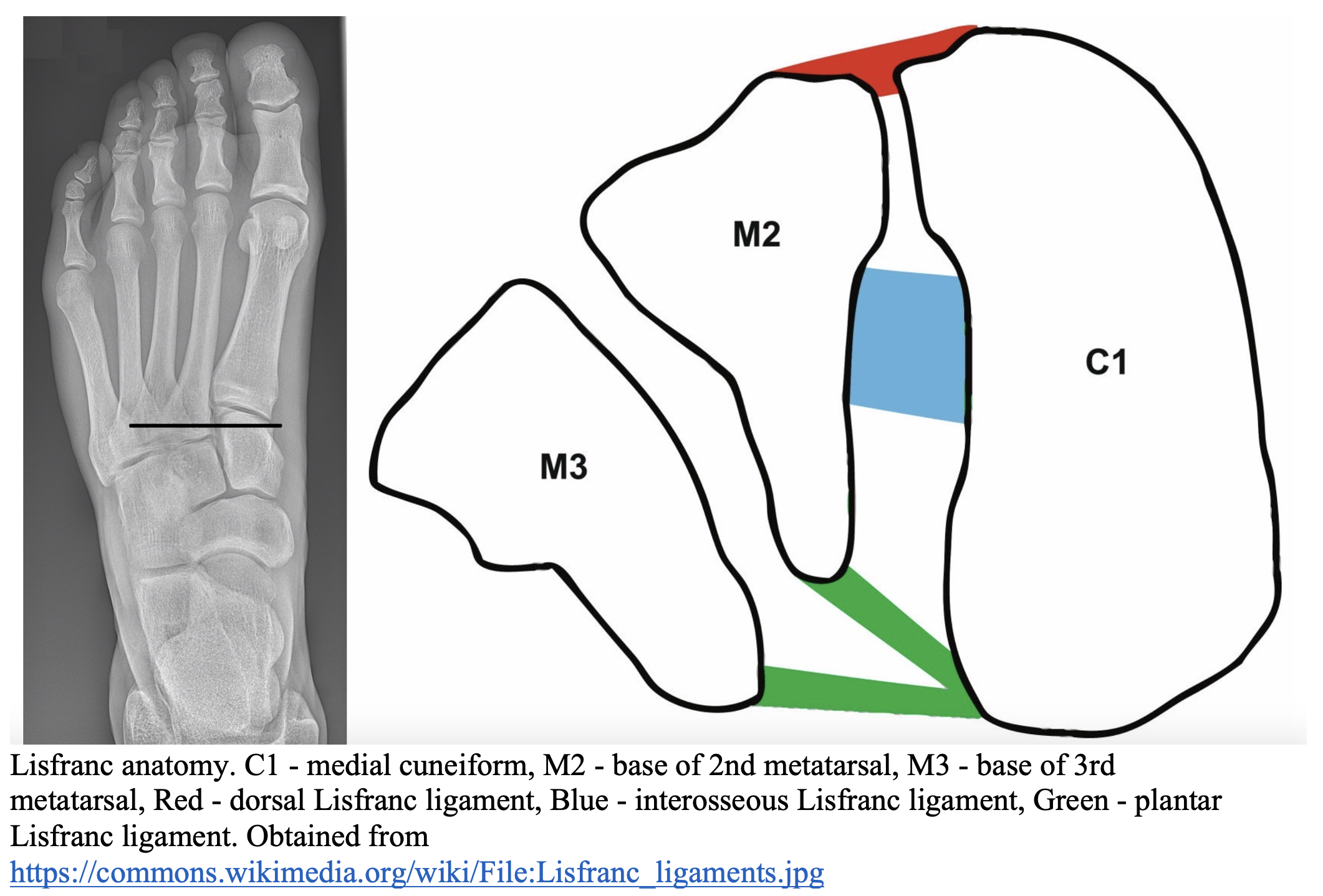 emDOCs Podcast - Episode 118: Lisfranc Injury - emDocs