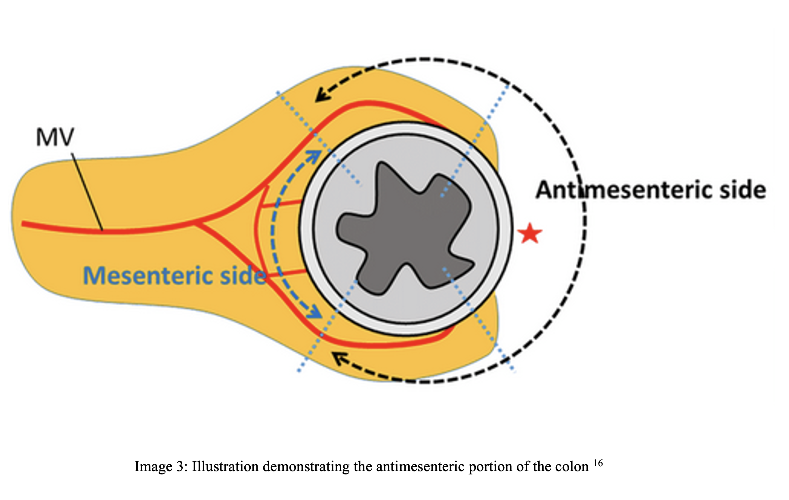 EM@3AM: Stercoral Colitis - emDocs