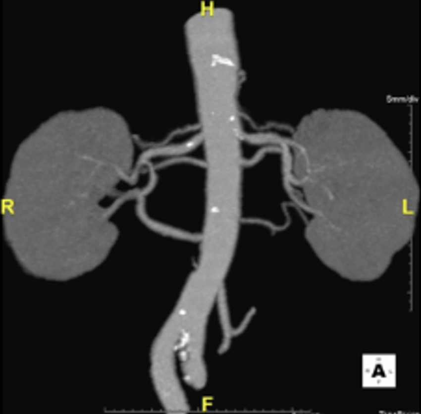Medical Malpractice Insights: What should we do when acute flank pain ...