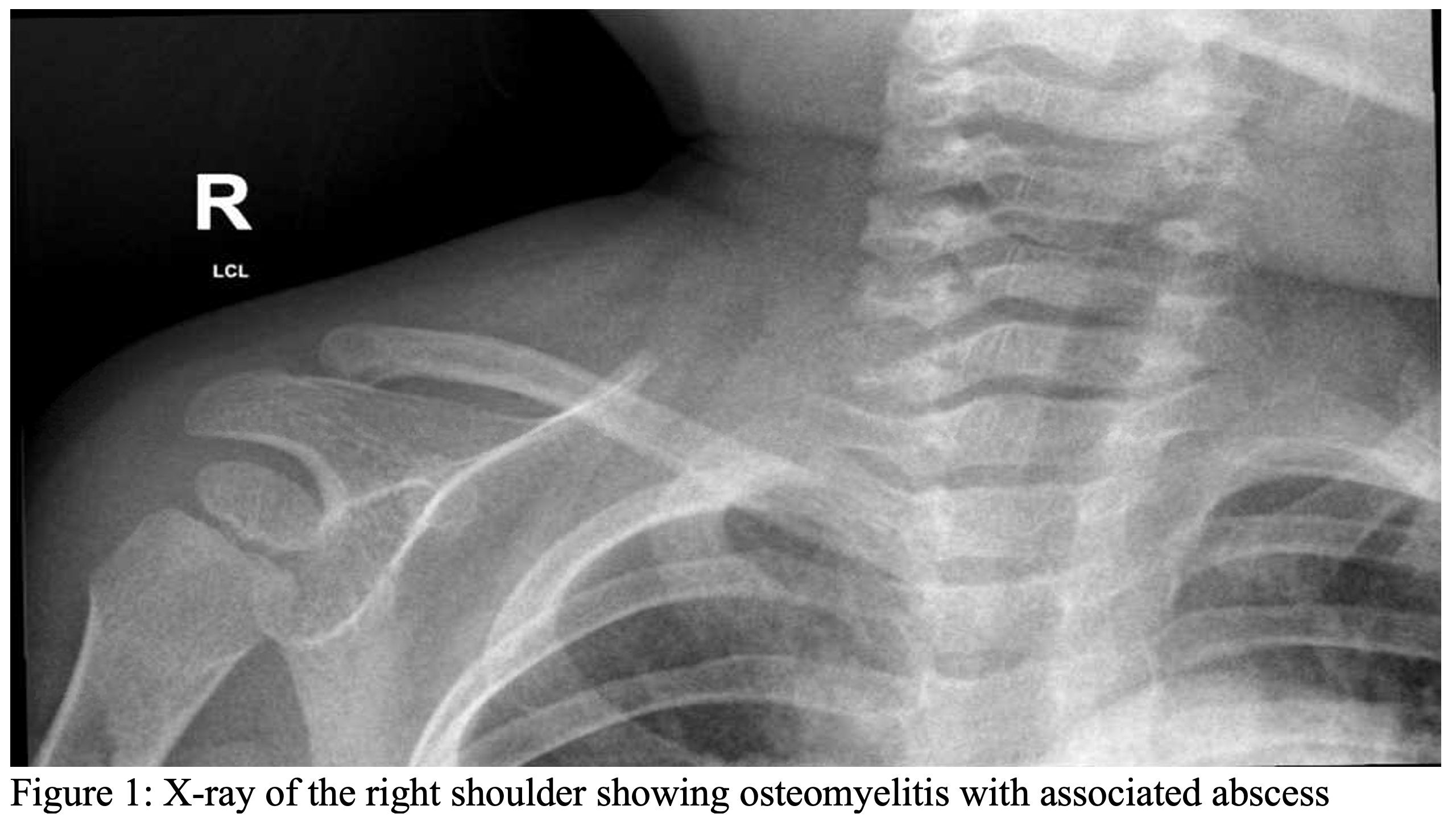 EM@3AM: Pediatric Osteomyelitis - emDocs